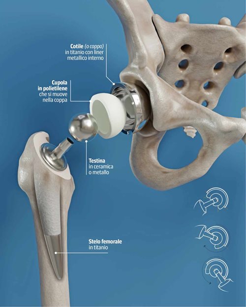 Protesi d’anca a doppia mobilità: ne giovano maggiormente i pazienti ...